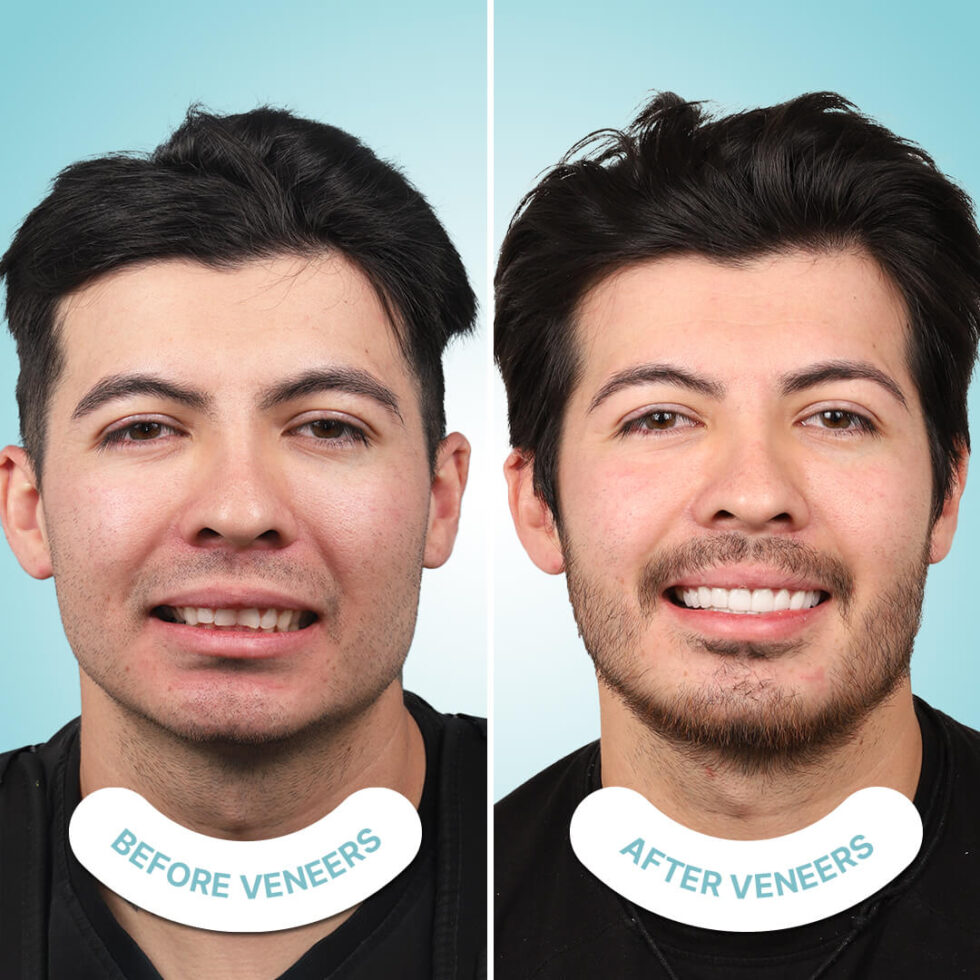 Transform Your Smile with Veneers in Tijuana: What You Need to Know - I ...